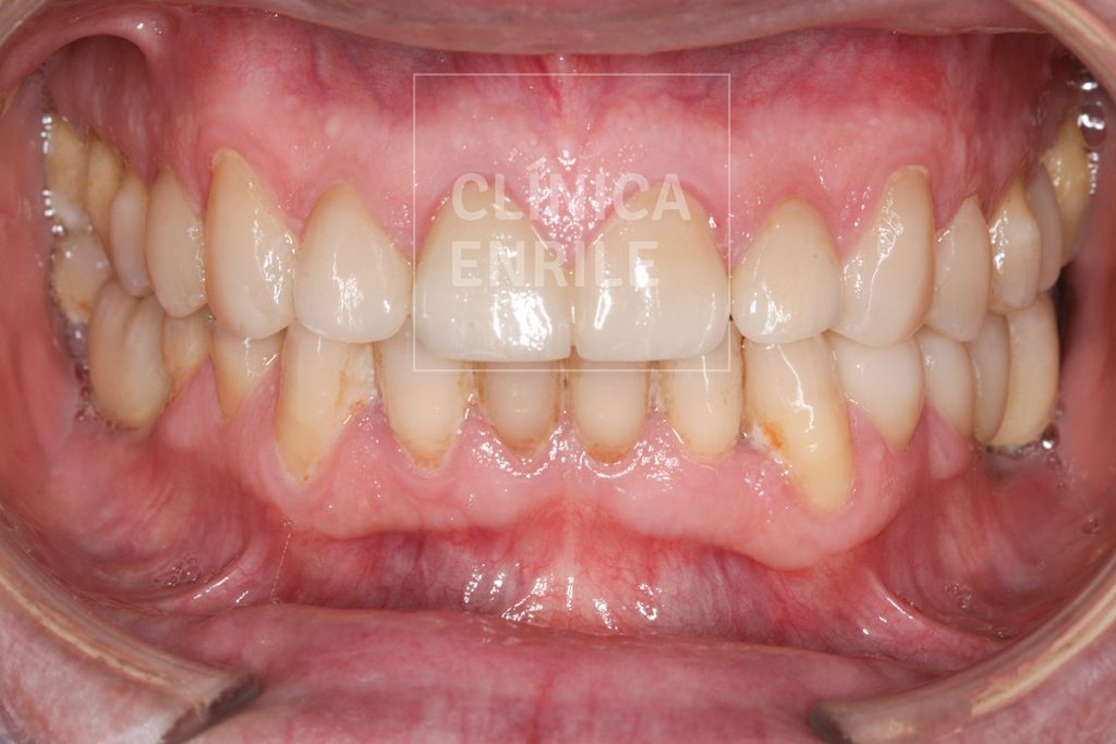Bruxismo: ¿Cómo dejar de apretar los dientes? - Clínica Enrile