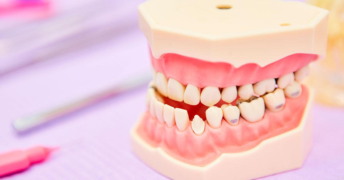 La importancia de tener una buena mordida dental / Maloclusión